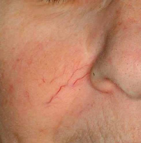 Couperose e teleangiectasie – pignattidermatologia